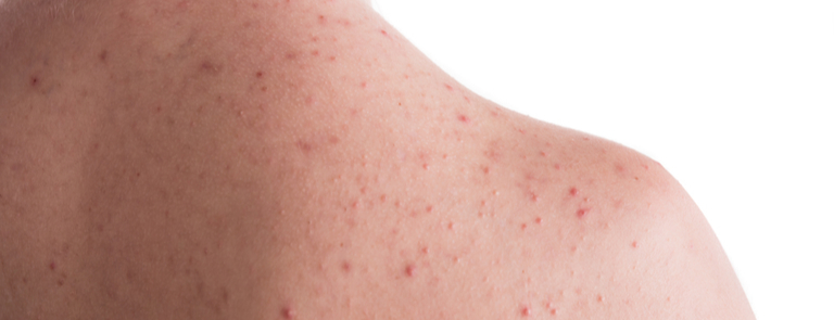 9 Ways To Manage Clogged Pores & Congested Skin | Holland & Barrett