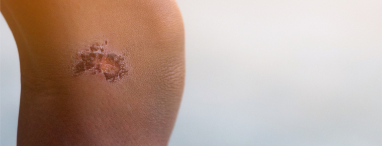 How To Get Rid Of Acne & Spots On Your Legs | Holland & Barrett