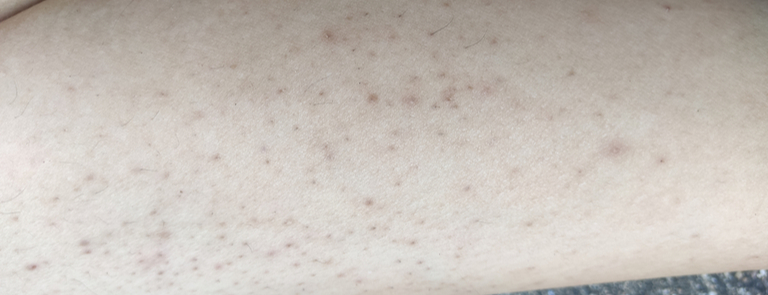 How To Get Rid Of Acne & Spots On Your Legs | Holland & Barrett