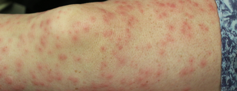 How To Get Rid Of Acne & Spots On Your Legs | Holland & Barrett