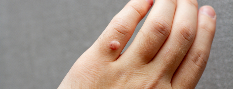 Warts On Hands & Fingers | Holland & Barrett