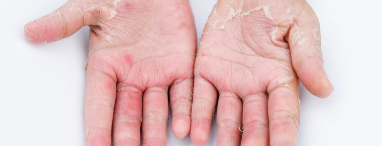 What Does Hay Fever Rash Look Like? | Holland & Barrett