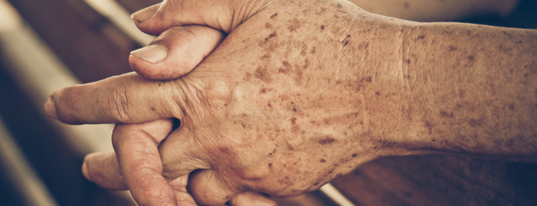 What Are Age Spots? | Holland & Barrett